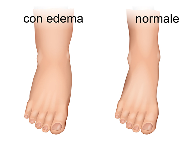 Edemi ed ematomi - SapereSalute