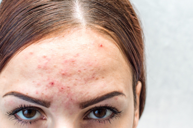 Acne comedonica: dalle cause alle soluzioni - SapereSalute