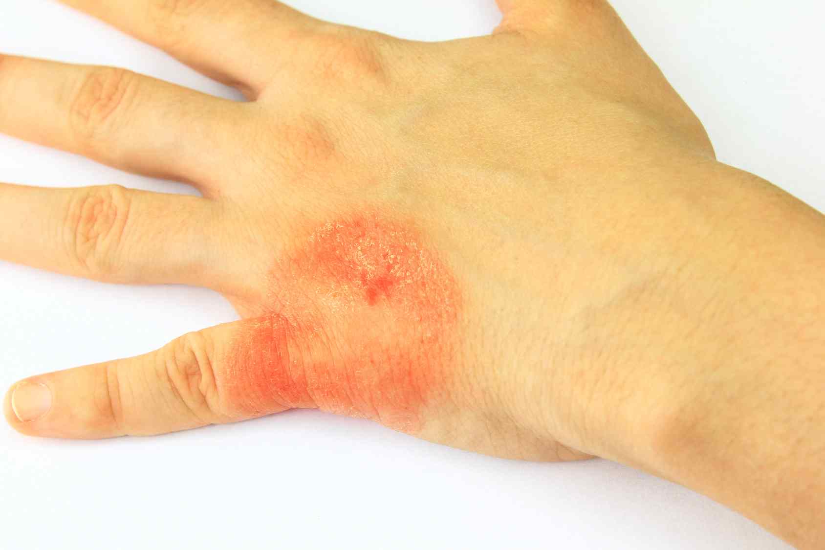 Dermatite allergica da contatto - SapereSalute