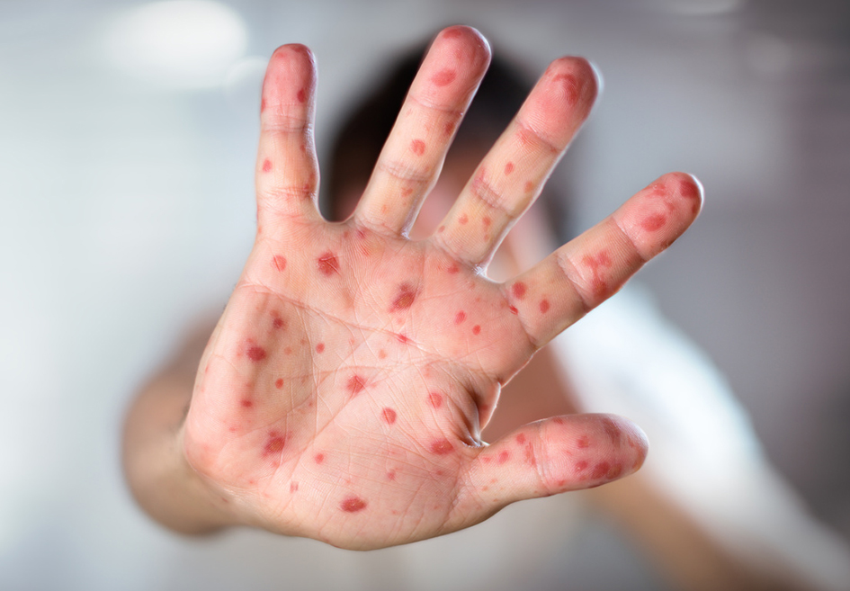 Morbillo: le dieci cose da sapere - SapereSalute