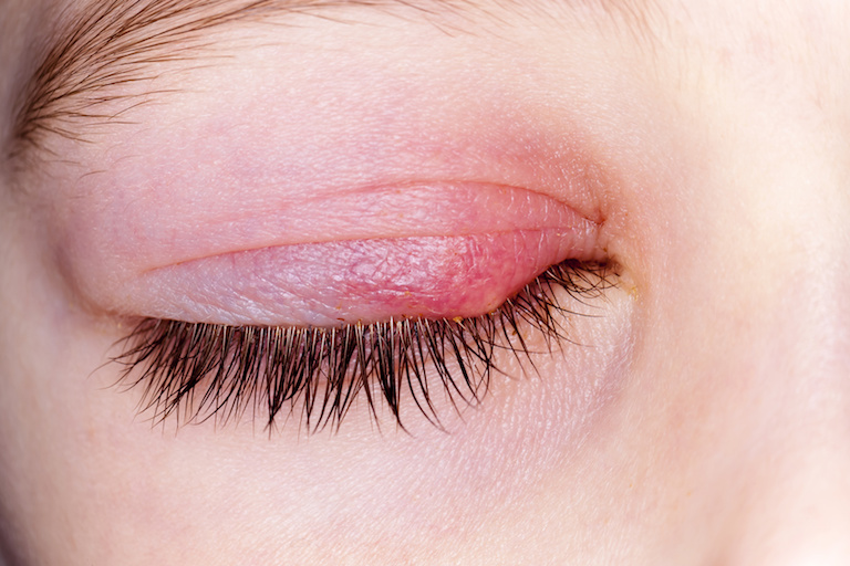 Blefarite: cause, sintomi e terapie - SapereSalute