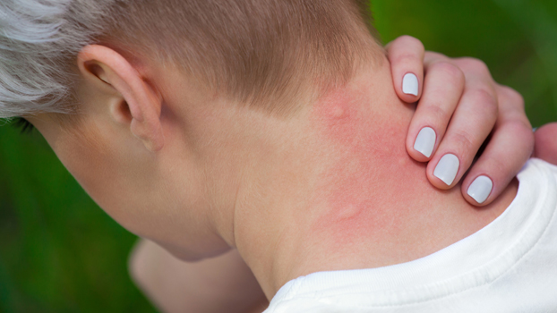 Riconoscere e curare le punture di insetti - SapereSalute